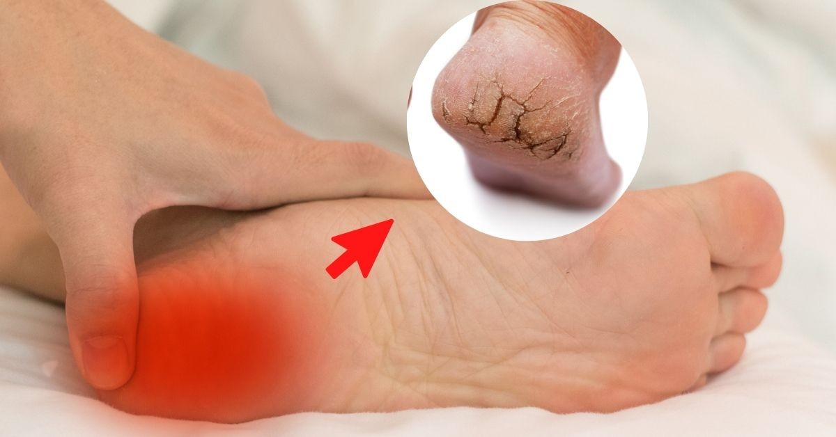 FASCITIS PLANTAR. SÍNTOMAS Y RIESGOS. INFORMACIÓN SUMINISTRADA POR ...